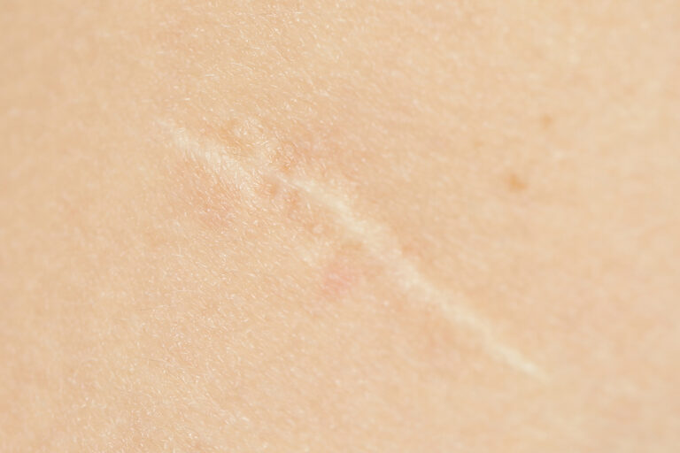 Scar Treatment Tampa FL - Skin Regeneration Tampa FL